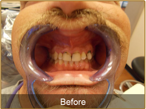 teeth cleaning before and after photos teeth cleaning before and after photos